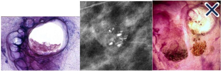 Calcifications Identified on Mammogram – Rodrigo Arrangoiz MS, MD, FACS ...