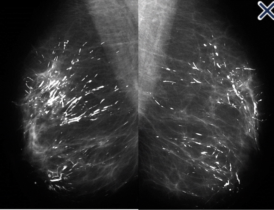 Types of Calcifications 1 – Rodrigo Arrangoiz MS, MD, FACS, FSSO