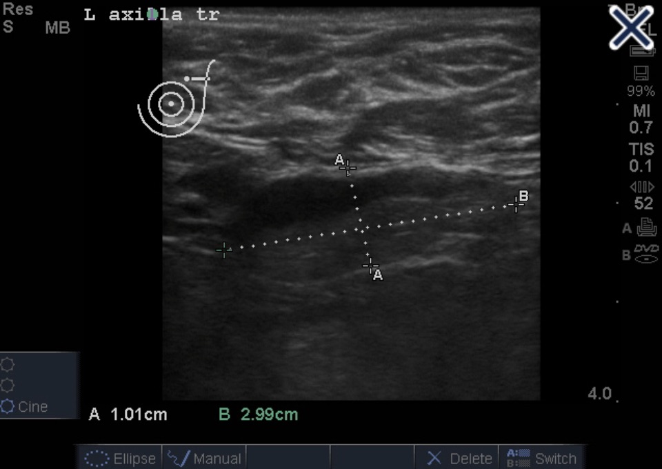 Ultrasound Appearance of Axillary Lymph Nodes – Rodrigo Arrangoiz MS ...