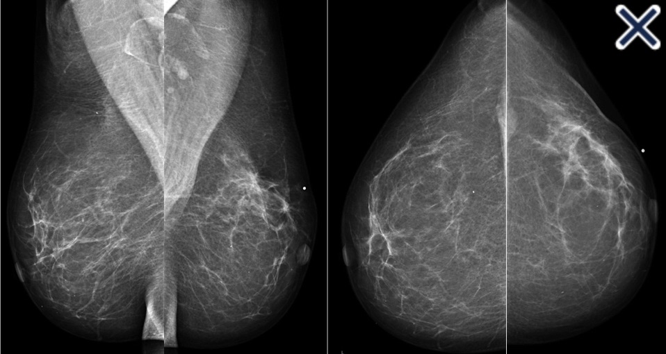 Mammographic Images in Diffusely Invasive Breast Cancer – Rodrigo ...