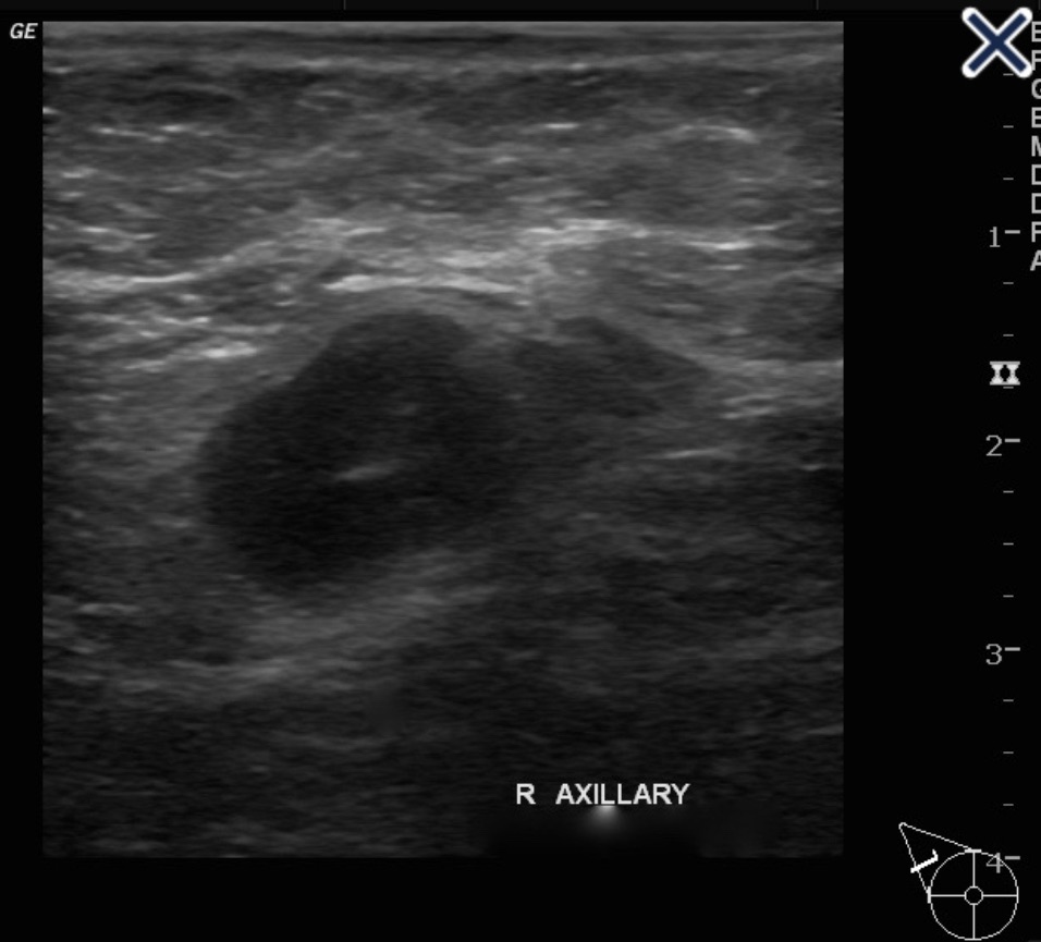 Sonographic Appearance of Lymph Nodes – Rodrigo Arrangoiz MS, MD, FACS ...