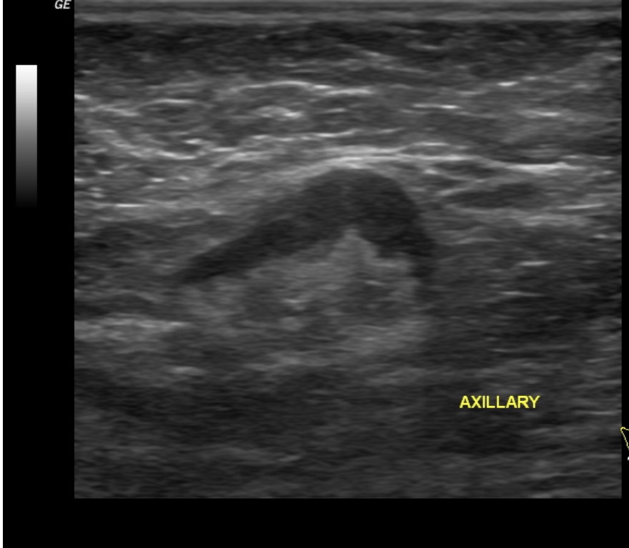 Axillary Ultrasound in the Evaluation of Breast Cancer Patients ...