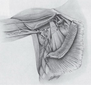 Axillary Dissection – Rodrigo Arrangoiz MS, MD, FACS, FSSO