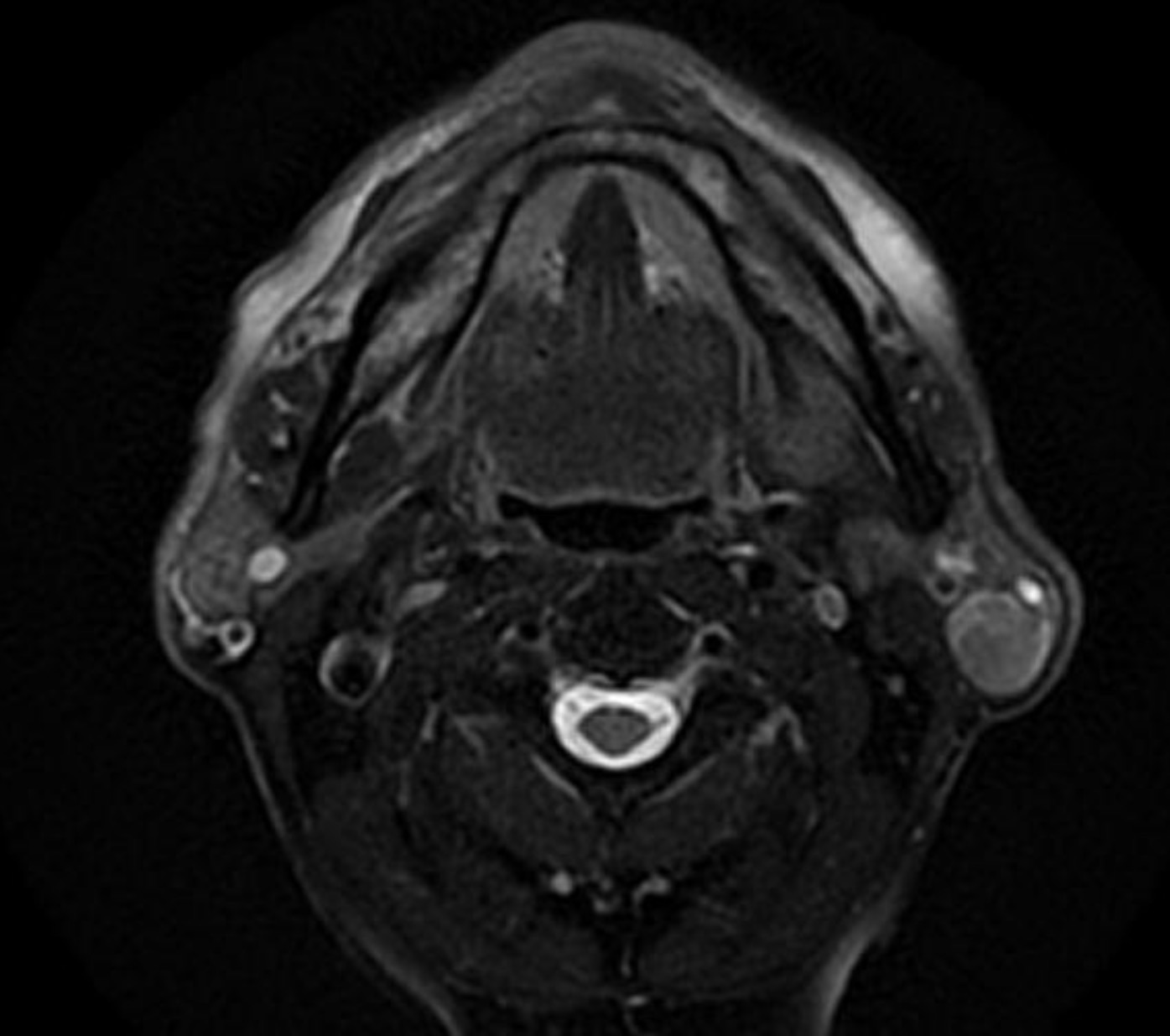 Warthin Tumor – Rodrigo Arrangoiz MS, MD, FACS, FSSO